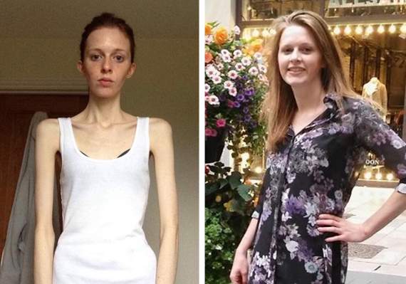 Anorexia Before And After Treatment