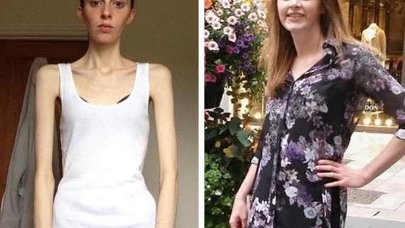 Anorexia sufferer urges others to seek help | cambrian-news.co.uk